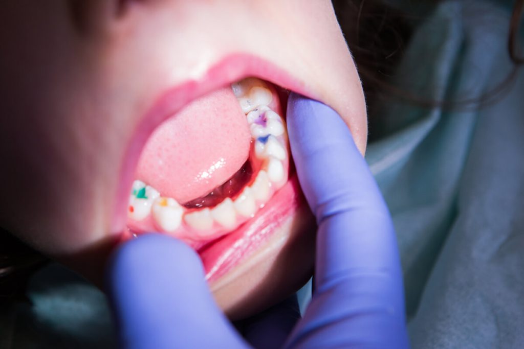 Kids Dental Fillings Near Me in Fort McMurray | Pediatric Cavity Treatment